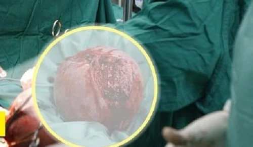 Phải cắt tử cung vì chủ quan để u 10 năm mới đi khám | Báo Tri thức và ...