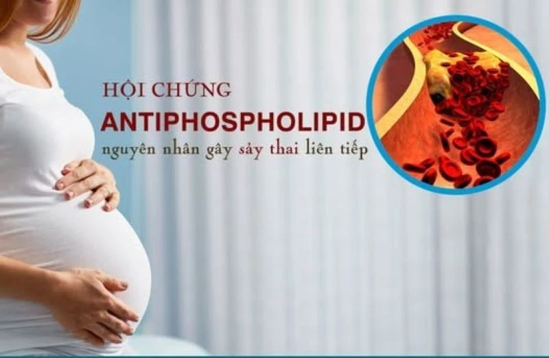 Hội chứng kháng phospholipid ảnh hưởng gì khi mang thai?