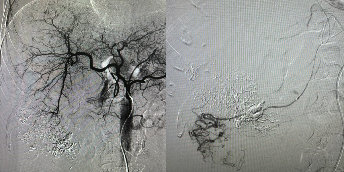 Đang trẻ khỏe bất ngờ vỡ u gan do ung thư | Báo Tri thức và Cuộc sống ...