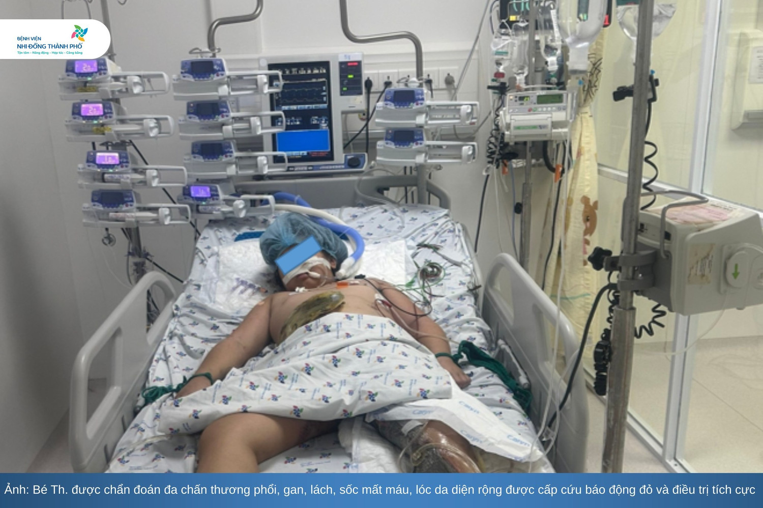 Hành trình 6 tháng cứu bé gái lóc da hiếm gặp do tai nạn giao thông ...