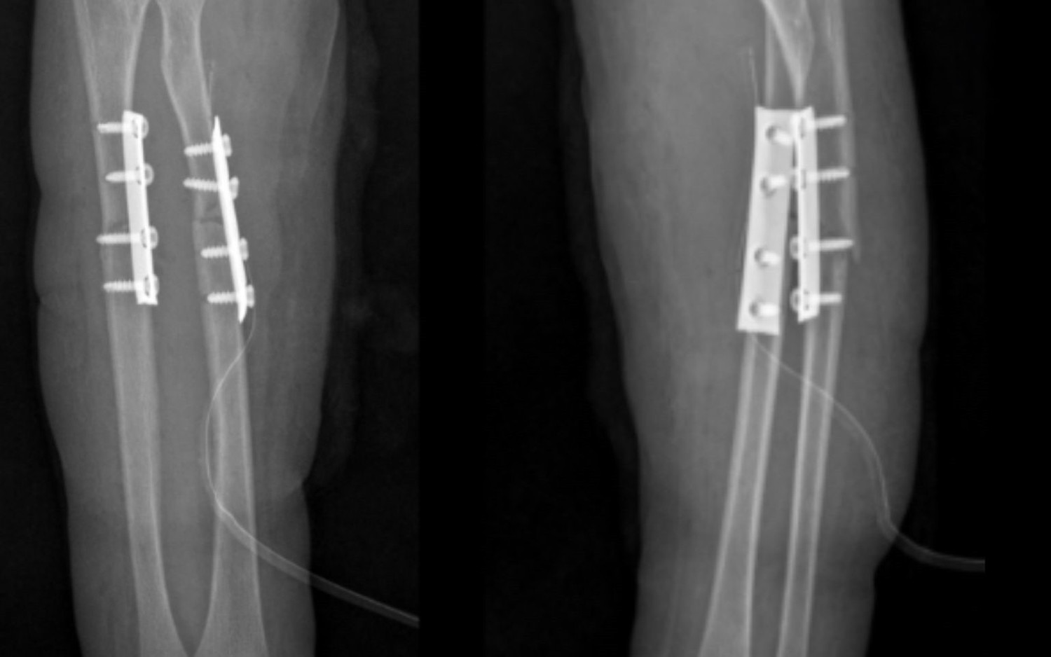 Bé trai 7 tuổi gãy xương cẳng tay, suýt mất vận động sau cú ngã xe đạp | Báo Tri thức và Cuộc ...