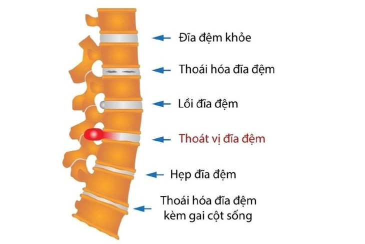 Chuyên gia mách dấu hiệu bệnh thoái hóa đĩa đệm cột sống thắt lưng ...